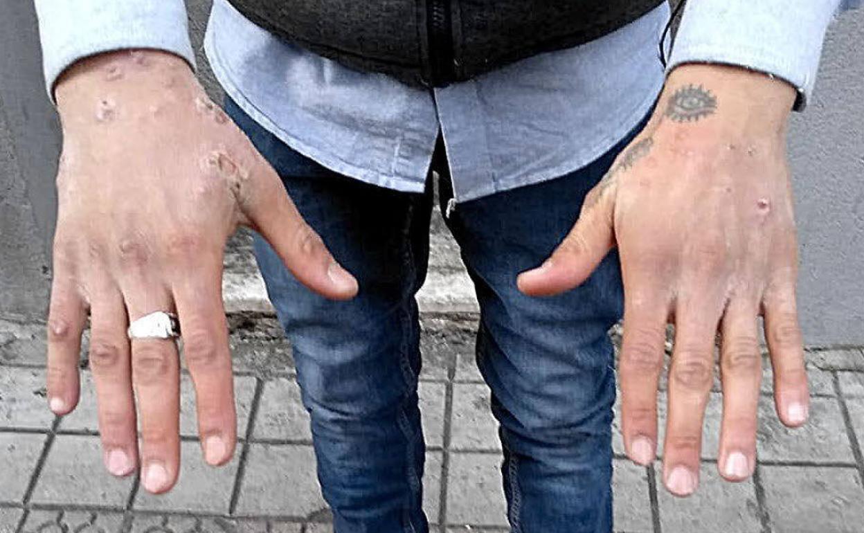 Los rastreadores del covid se incorporan al control de la sarna en Euskadi | El Correo